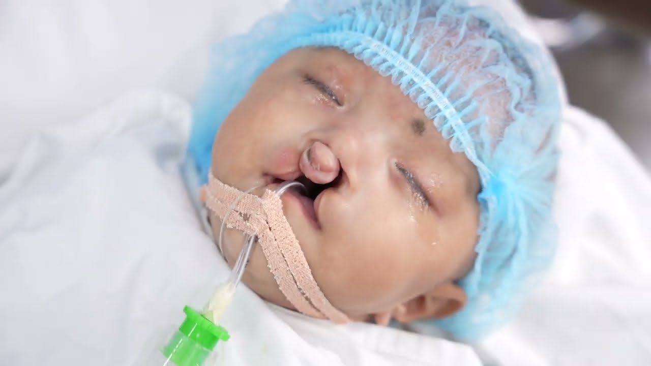 Cleft Cutie Baby goes under Anesthesia - YouTube