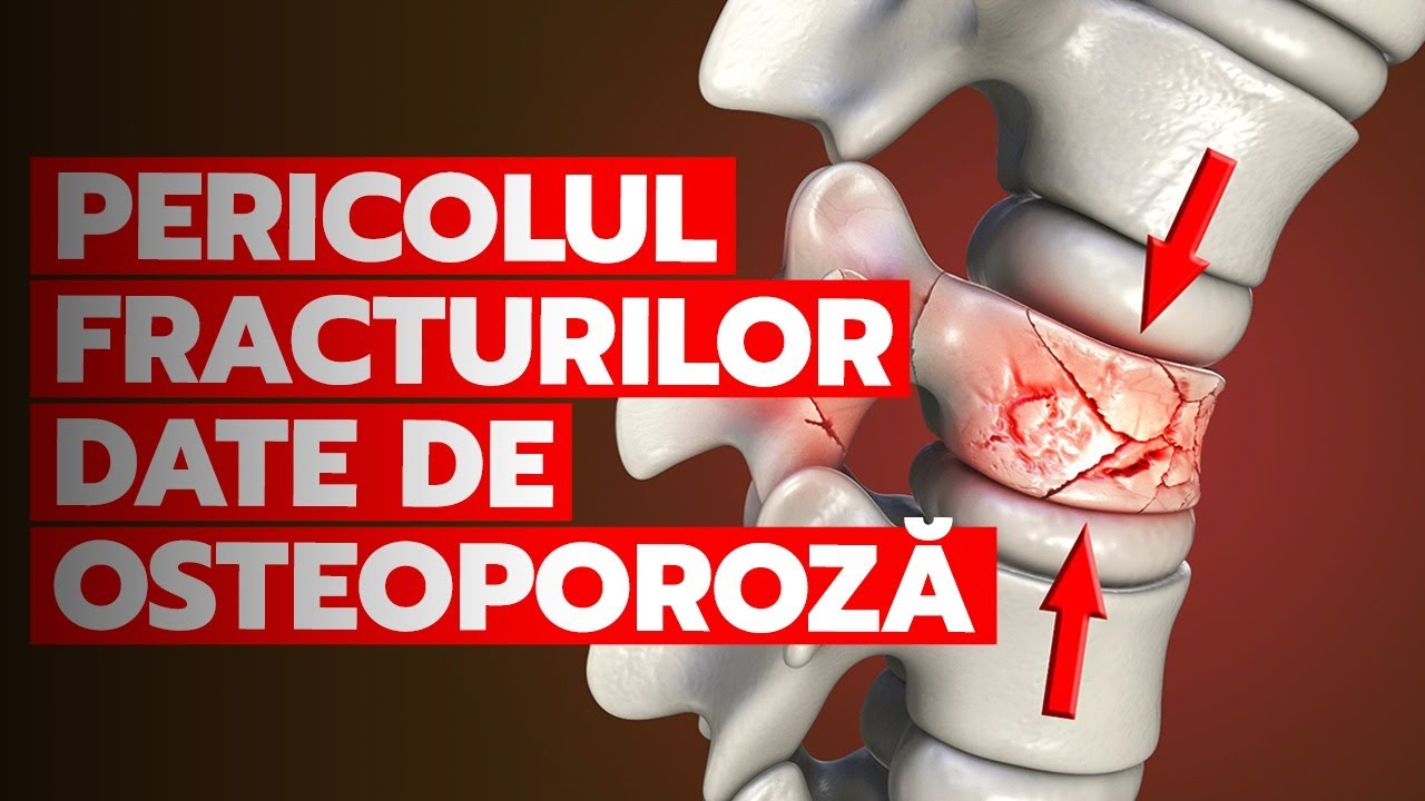 Fracturile date de osteoporoză: cât de periculoase sunt? - YouTube
