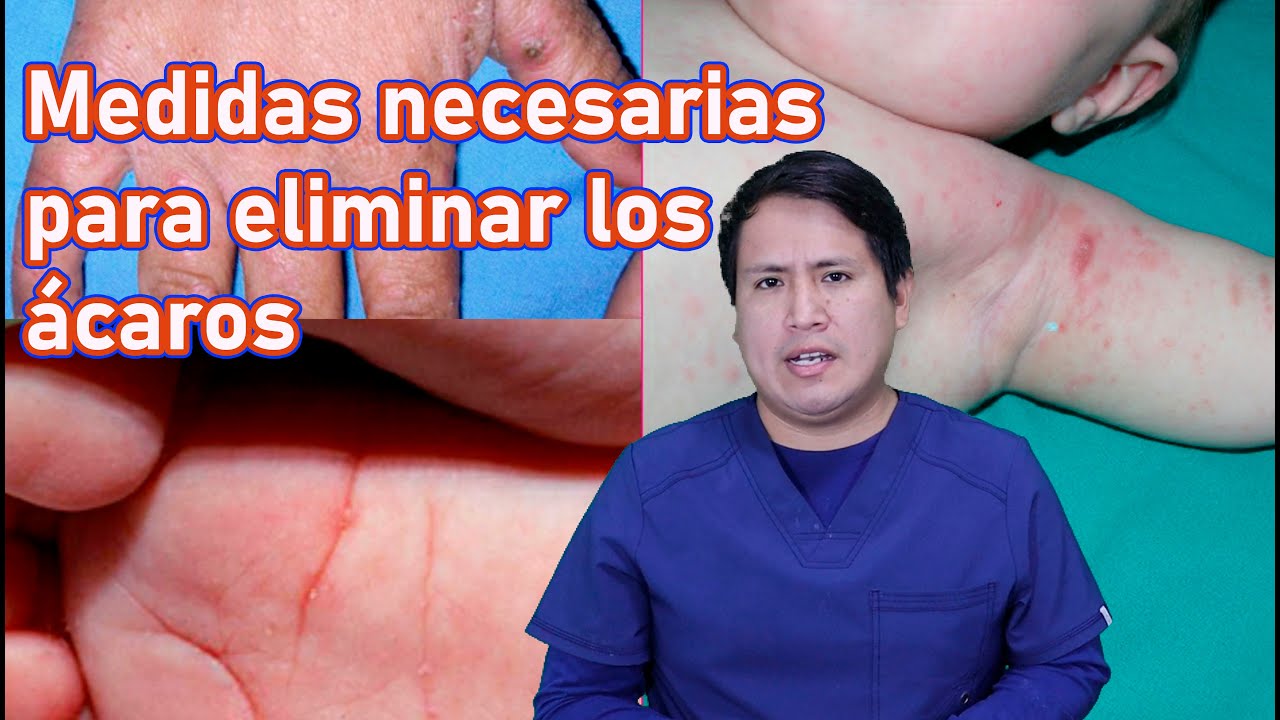 Medidas necesarias para acabar con la sarna humana o escabiosis 🕷🕷🕷🕷🕷🕷🕷 ...