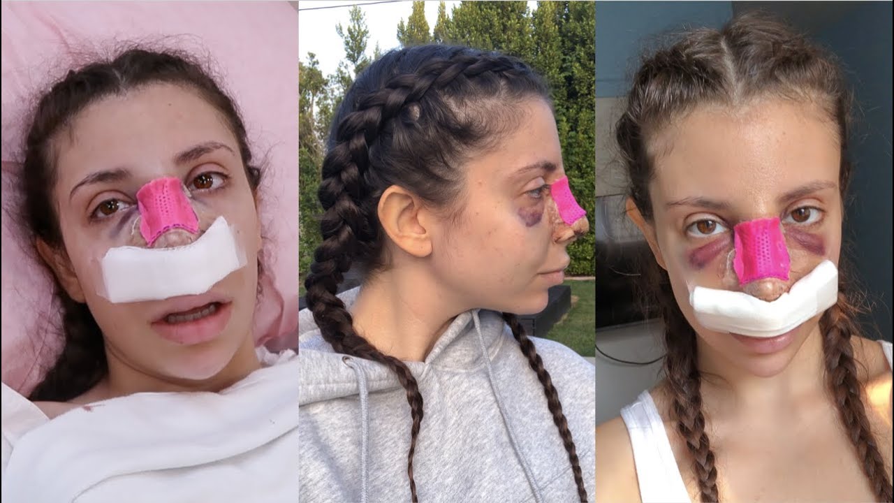 I GOT A NOSE JOB & THIS IS THE RECOVERY VLOG! - YouTube