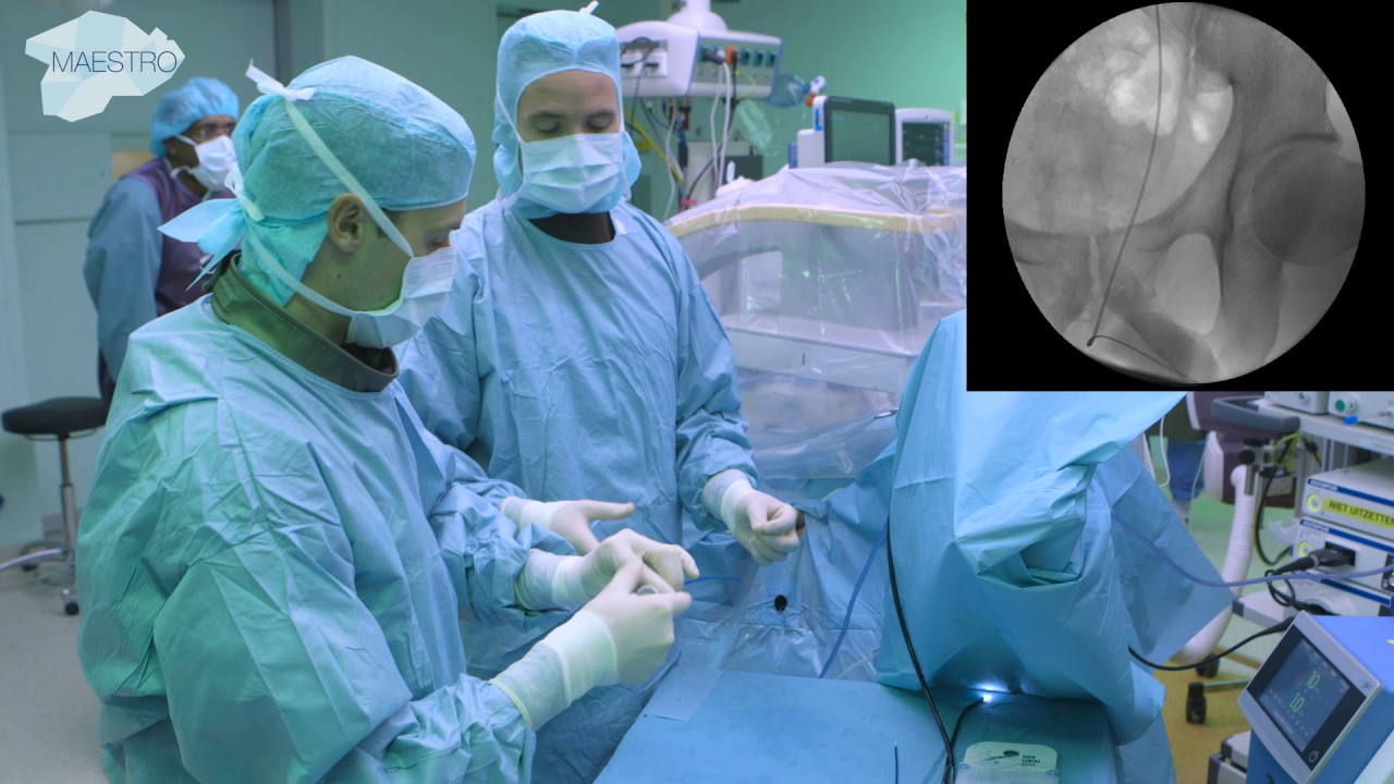 Ureteral Access Sheath - Placement & Decription - YouTube