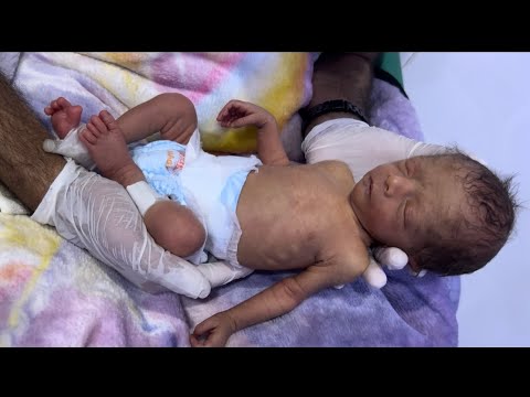 15 Days Premature Baby Condition Improved  Good Feeding NICU Preemie Progress 👶