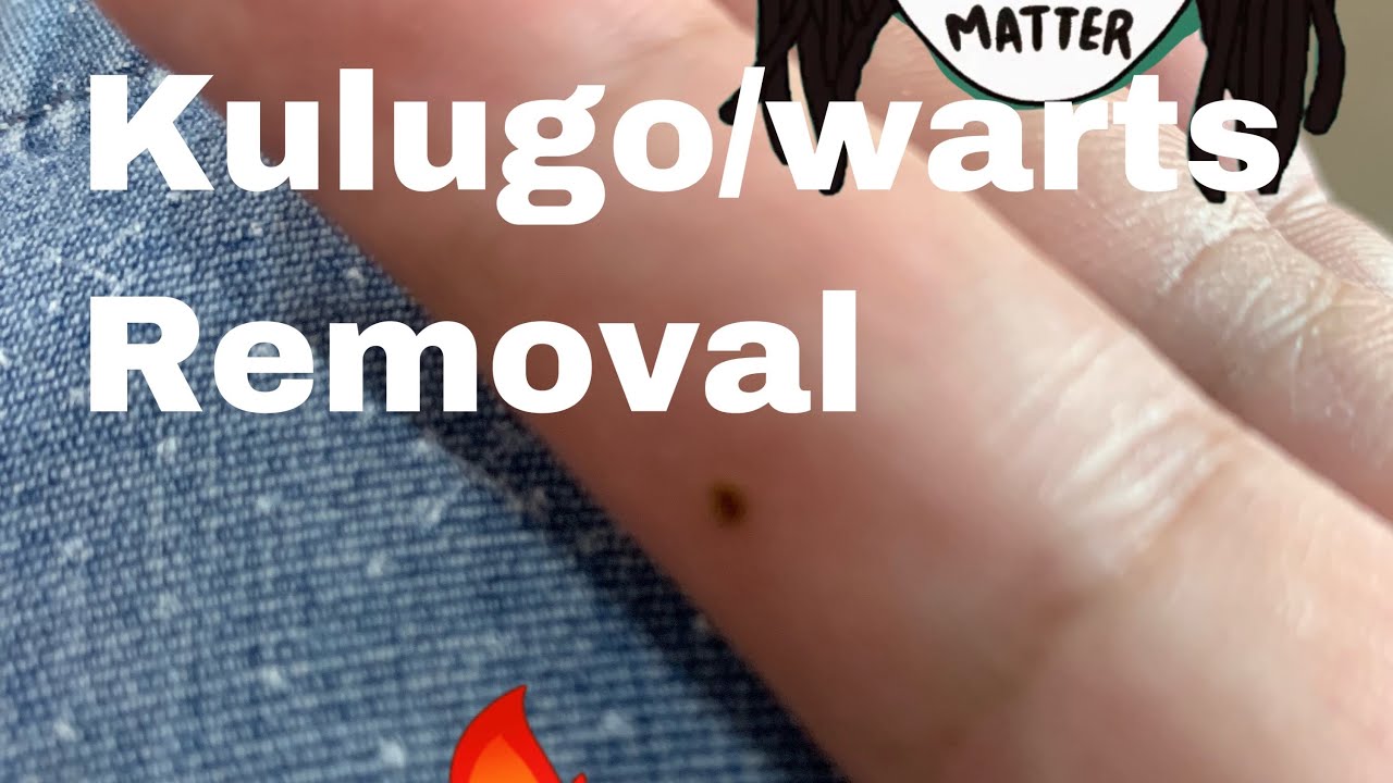 Kulugo/warts removal - YouTube