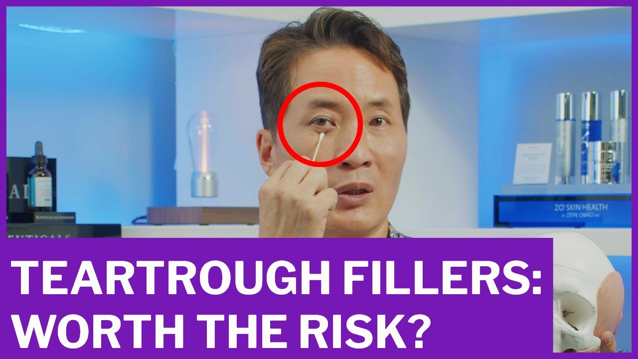 TEARTROUGH FILLERS: ARE THEY WORTH IT? | Dr. David Yew - YouTube