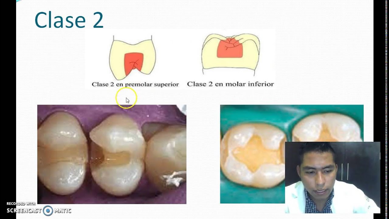 clases de cavidades en la odontologia gilberto valencia - YouTube