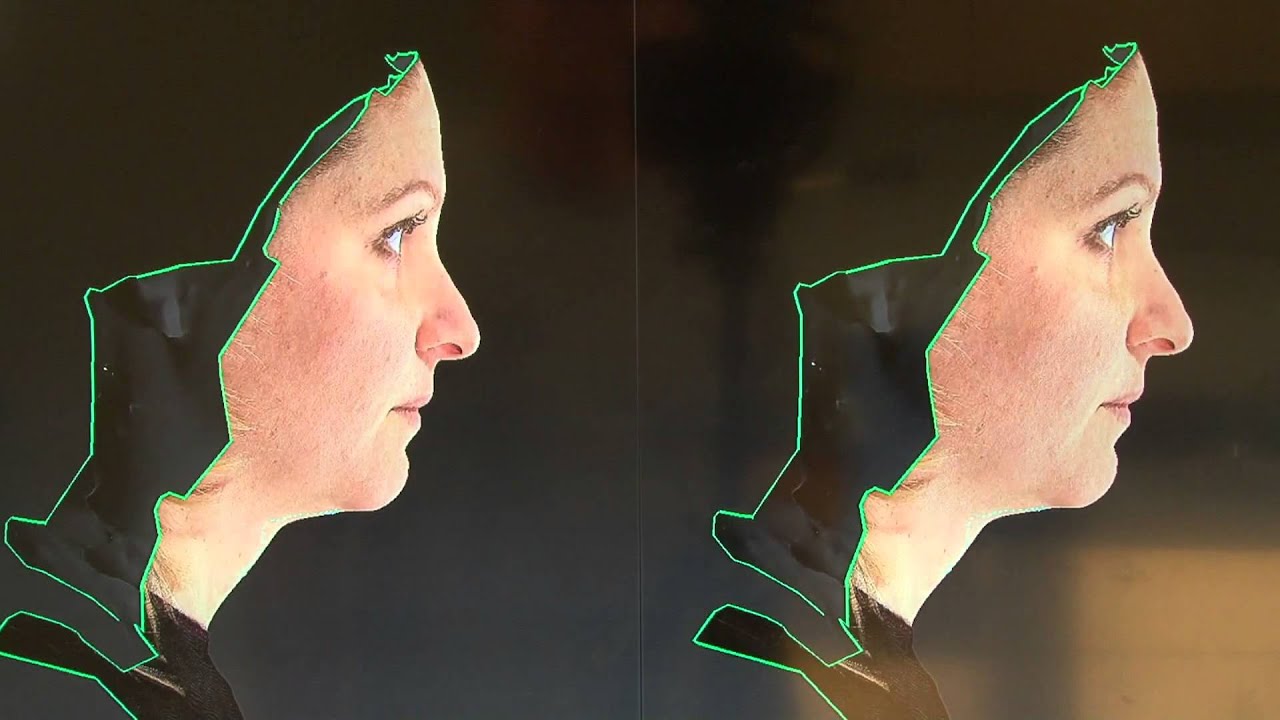 Vectra 3D Imaging at WCosmetic Surgery - YouTube