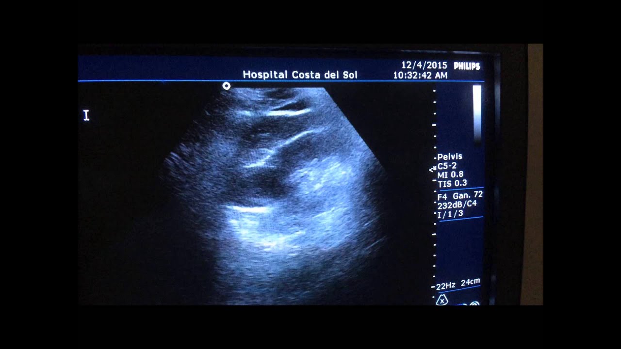 Gran quiste simple renal derecho - YouTube