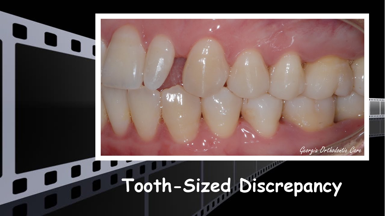 Tooth-Sized Discrepancy - YouTube