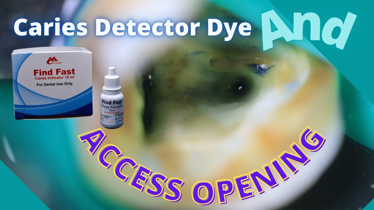 ⚪️Caries Detector Dye🟣Access Opening🟢 - YouTube