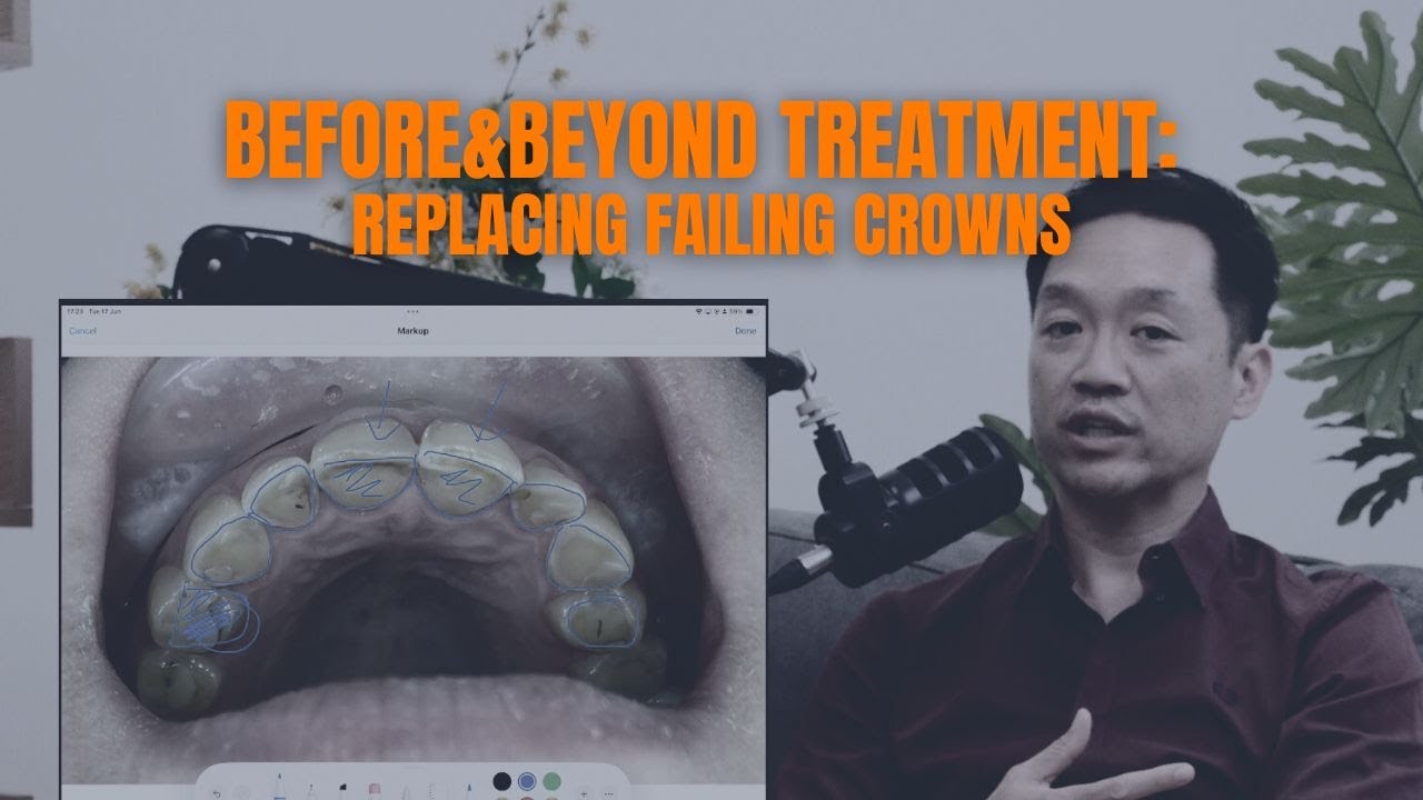 Replacing Failing Crowns | BEFORE & BEYOND EP8 - YouTube