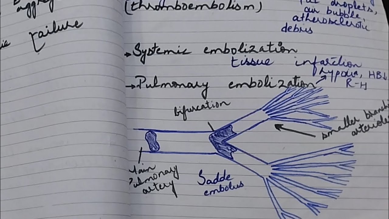 Embolism | Thromboembolism | pulmonary embolism | general pathology ...