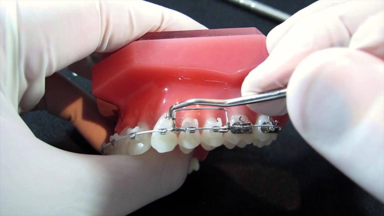BIOMECÁNICA CON MINI IMPLANTES # 1 (DISTALIZACIÓN) - YouTube