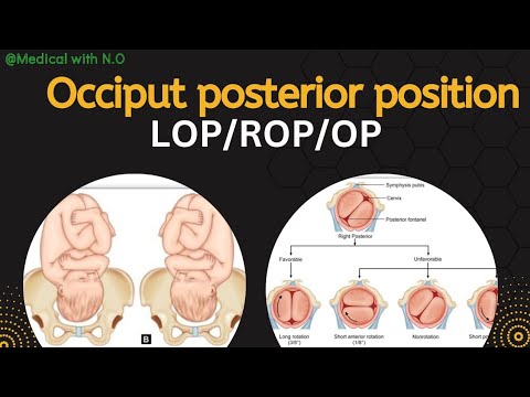 occiput posterior|| right occipitoposterior | left occipitoposterior # ...