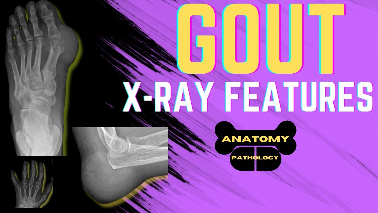 Gout (X-ray Features) - YouTube
