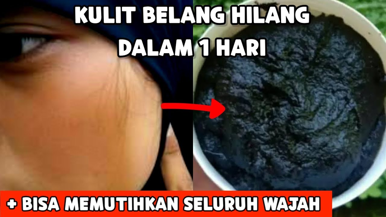WAJAH BELANG HILANG DALAM 1 HARI | CARA MENGHILANGKAN KULIT BELANG DI ...