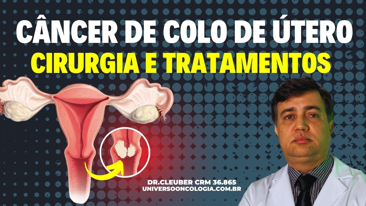 Câncer de Colo de Útero: Cirurgia e Tratamentos - YouTube