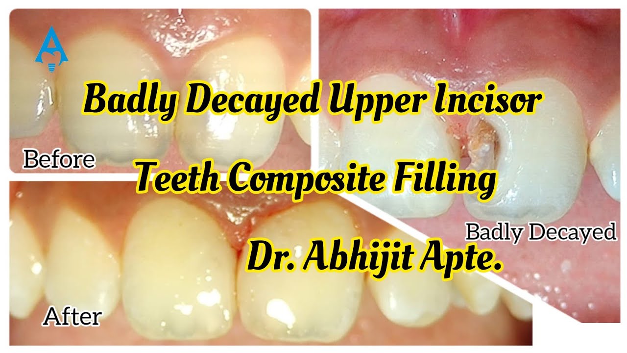 Badly Decayed Incisor Teeth Composite Filling | Before And After ...