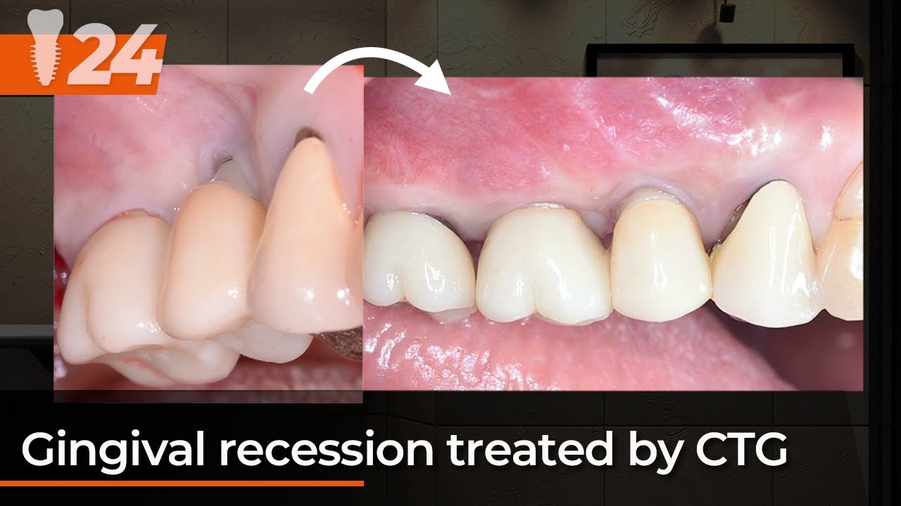 #15 Gingival recession treated by CTG [24th] - YouTube