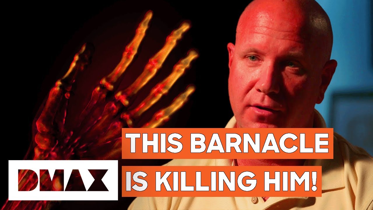 This Barnacle Has Infiltrated His Body And Is Trying To Kill Him ...