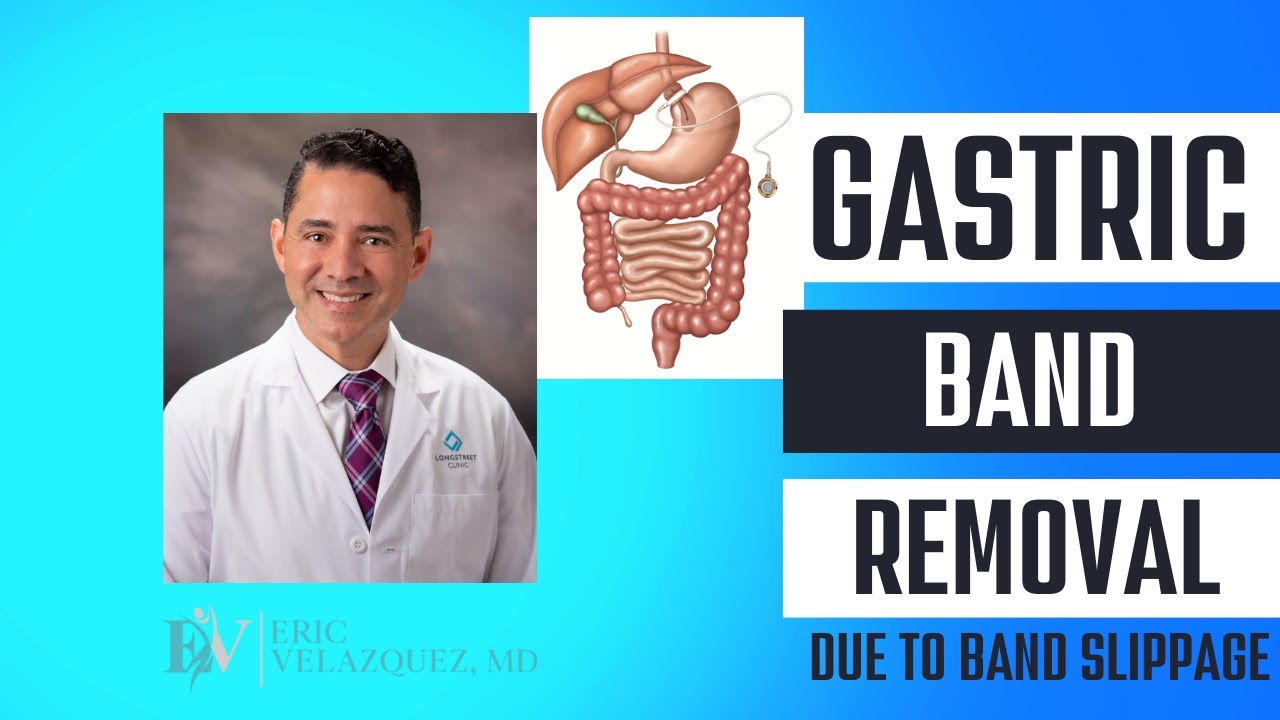 Gastric band removal after slippage - YouTube