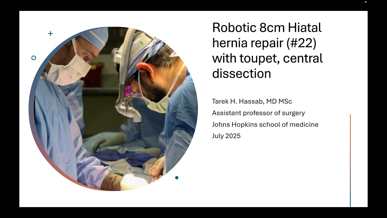 Robotic 8cm Hiatal hernia repair w/toupet (#22) showing central & high ...