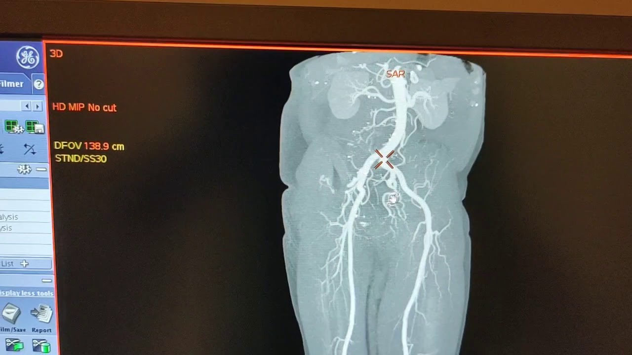 How to create VR view of CTA Lower Extremity . - YouTube