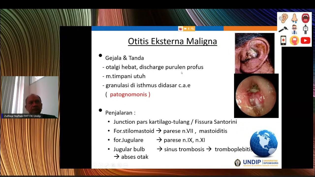 Otitis Eksterna Maligna - YouTube