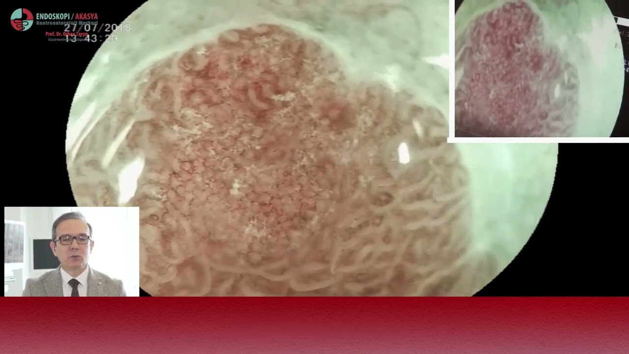 Barrett Esophagus , advanced endoscopy for early diagnosis of dysplasia ...