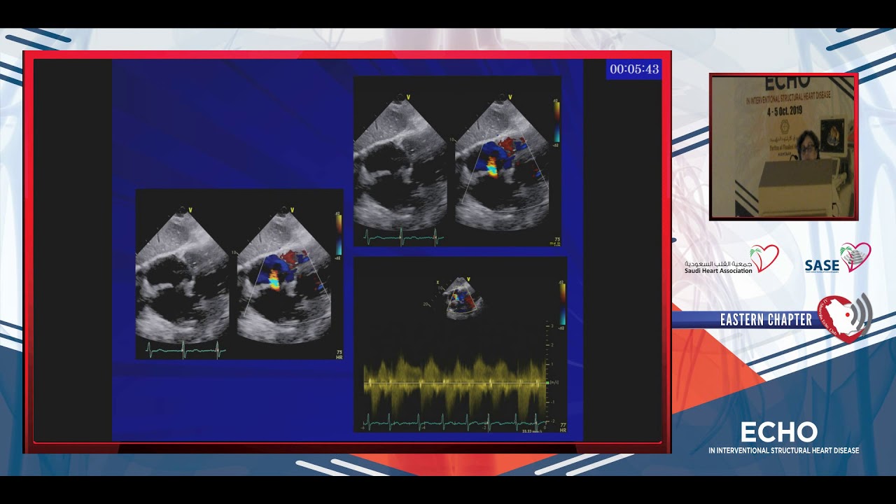 Case Presentation: Percutaneous Balloon Mitral Valvuloplasty for Mitral ...