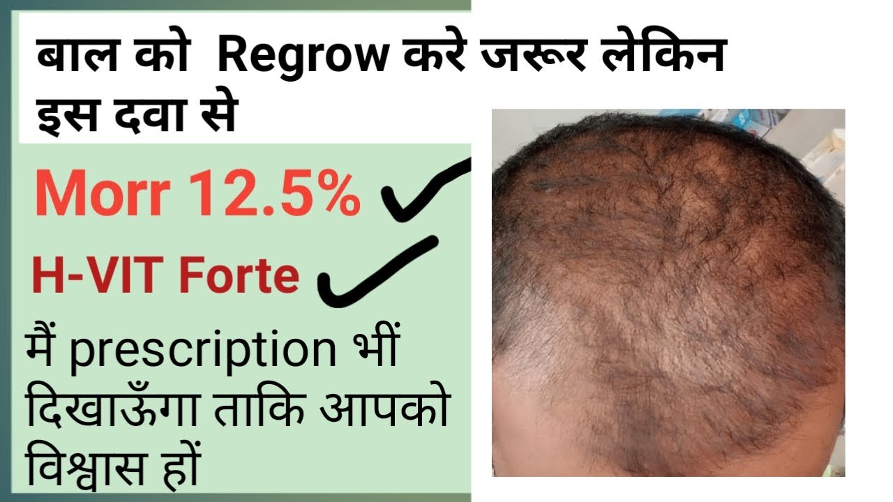 How to regrow hair using minoxidil, Morr 12.5%, H-vit forte tablets ...