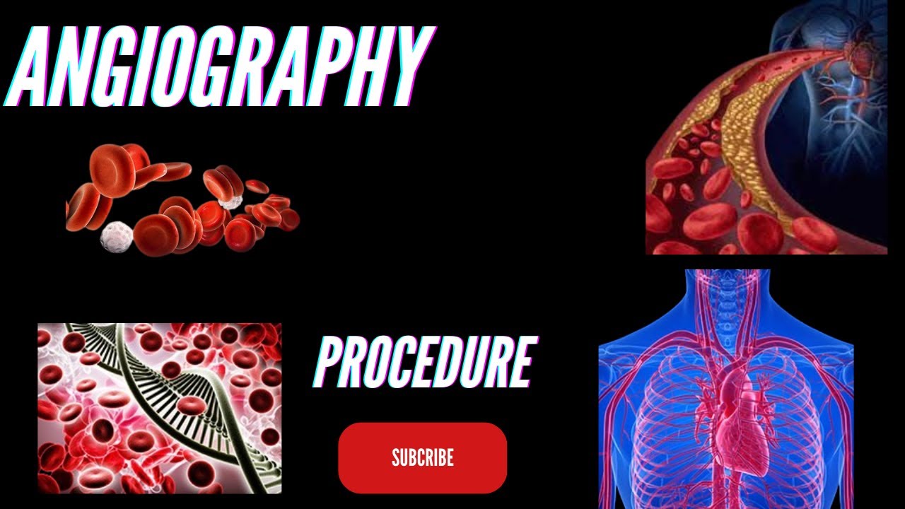 Angiography Procedure | Coronary Angiography | Cardiac Catheterization ...