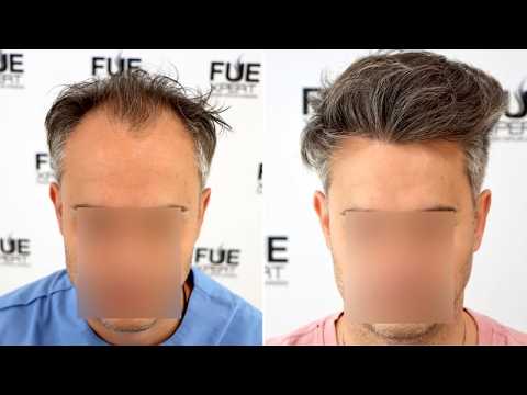 Trasplante Capilar FUE de 3200 injertos por el Dr. Juan Couto en FUEXPERT CLINIC - Madrid, España