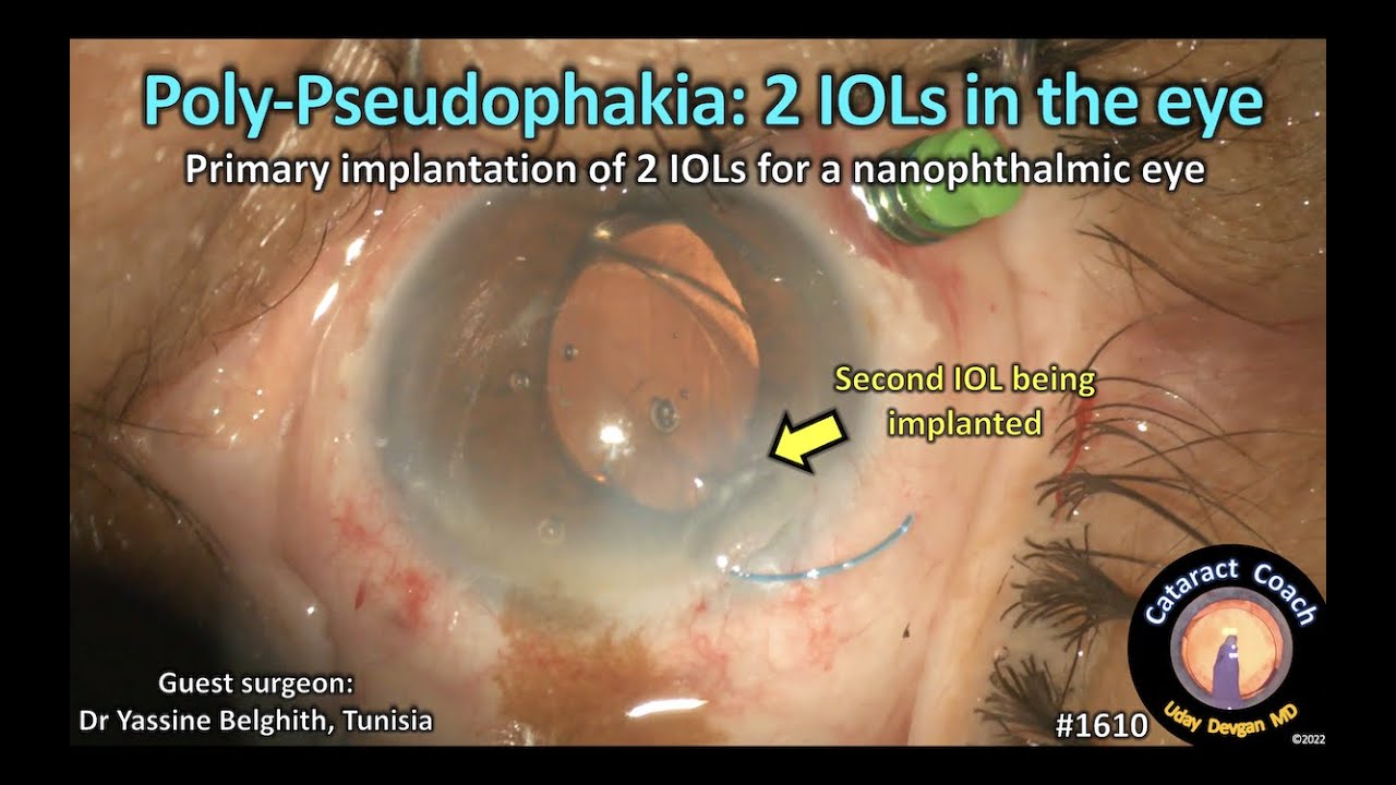 CataractCoach 1610: poly pseudophakia: 2 IOLs in the eye - YouTube