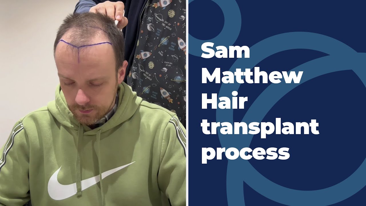Sam Matthew Hair Transplant Process - YouTube