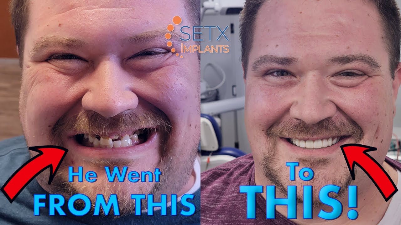 How New Teeth In A Day Changed Jason's Life - YouTube