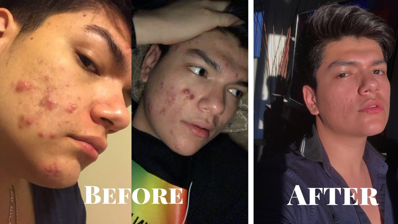 Accutane Epuris Acne Journey Youtube