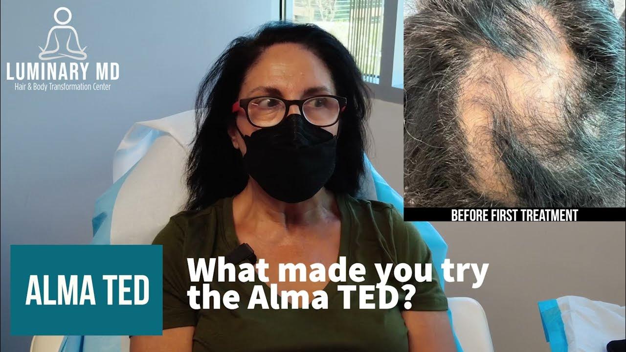 Patient Testimony Using The Alma TED For Hair Restoration In Orange patient-testimony-using-the-alma-ted-for-hair-restoration-in-orange