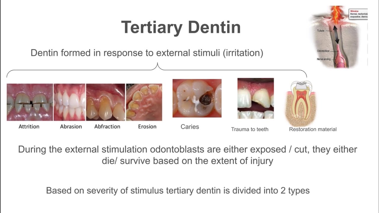 Tertiary dentin-reparative dentin & reactionary dentin #dentistry # ...