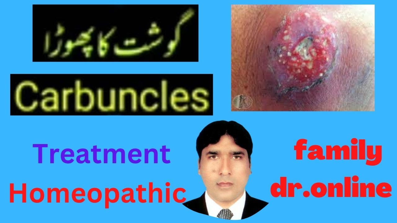 Carbuncle Abscess Boil Cause Symptoms and Treatment in Homeopathic ...