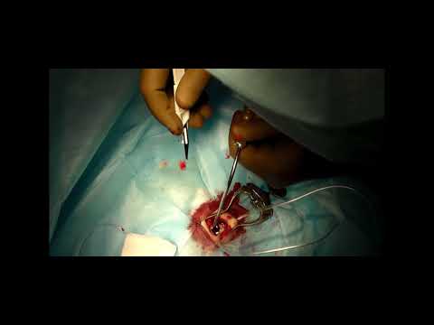 Drainage of subdural haematoma - YouTube