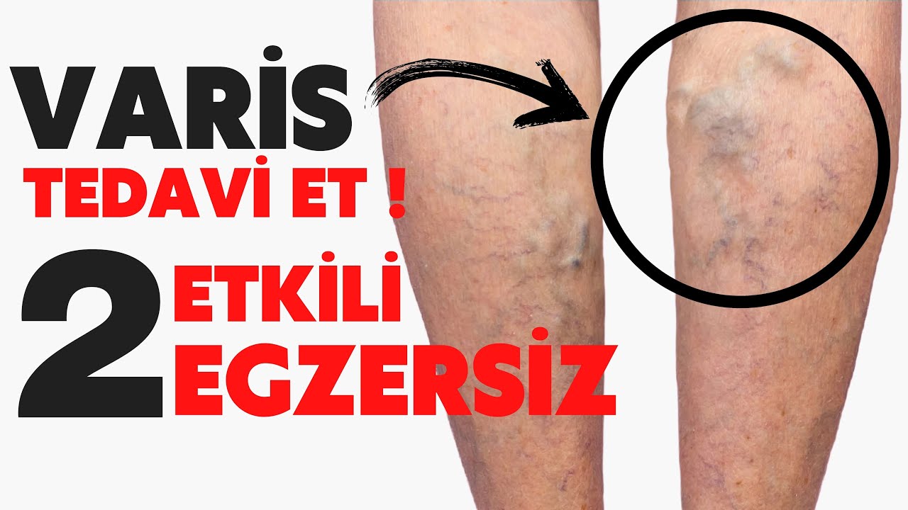 Bacak Ağrısı neden olur ? Bacak Kan Dolaşımı Hızlandırmak ve Varis için ...