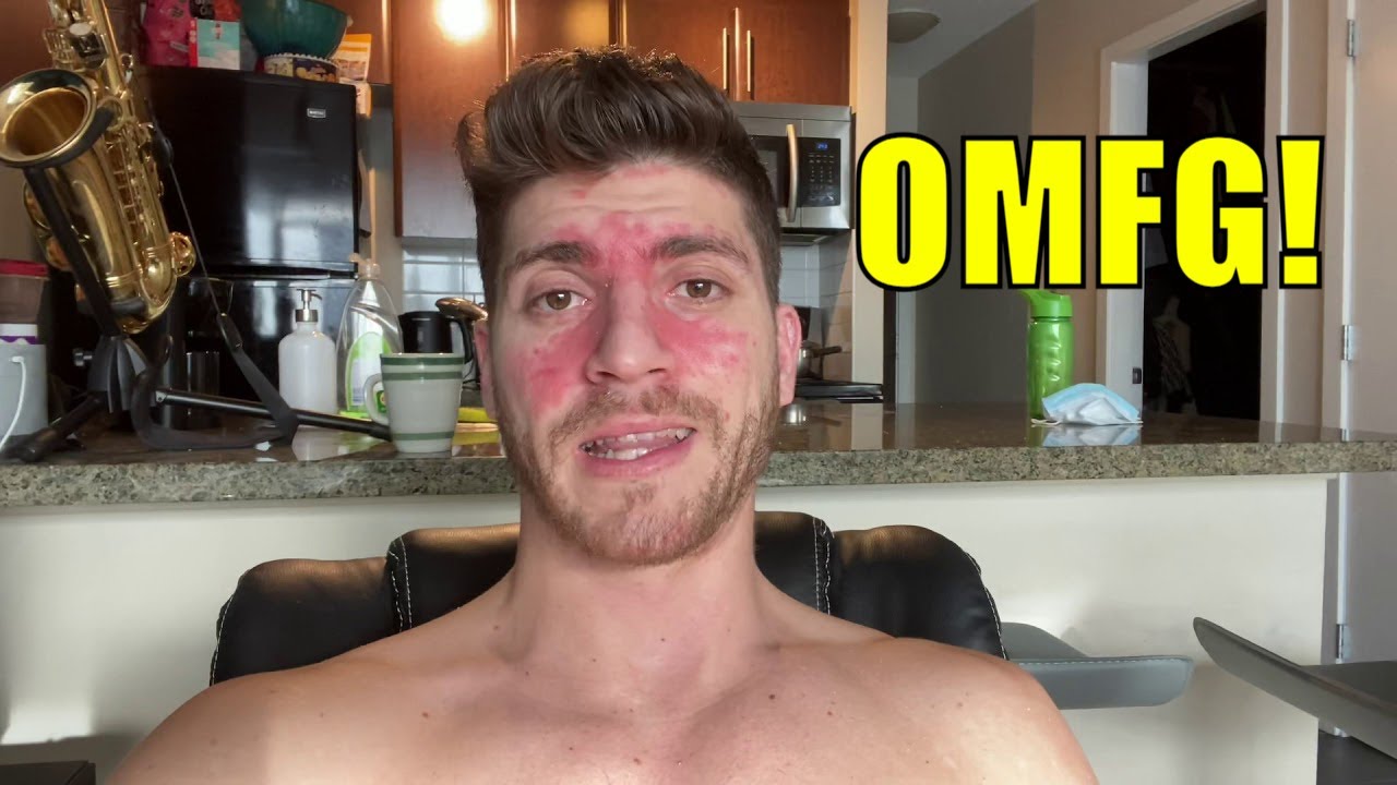 Psoriasis Red Face - Probably at its worst I’ve ever had it - YouTube