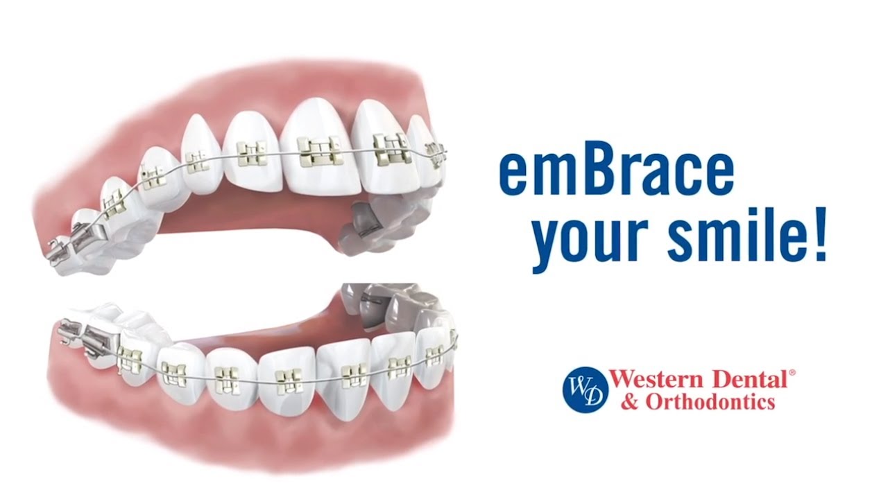 Embrace Your Smile: Start Your Braces Journey | Western Dental ...