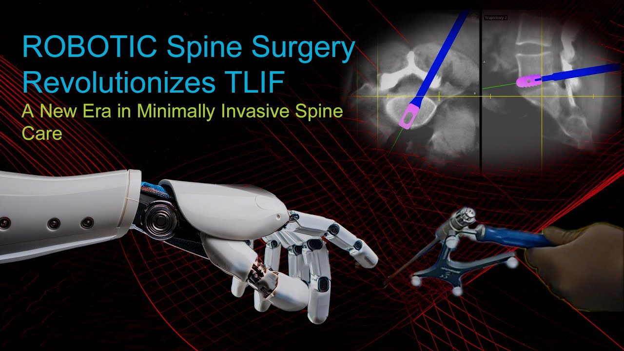 ROBOTIC Spine Surgery Revolutionizes TLIF: A New Era in Minimally ...
