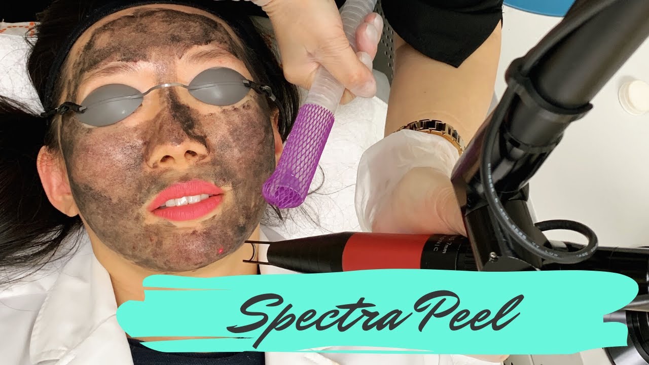 Spectra Laser Peel | Hollywood peel | full face rejuvenation - YouTube