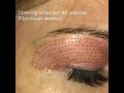 Fibroblast / Plasma Pen SCAM Fibroblast Review on eyelids - YouTube