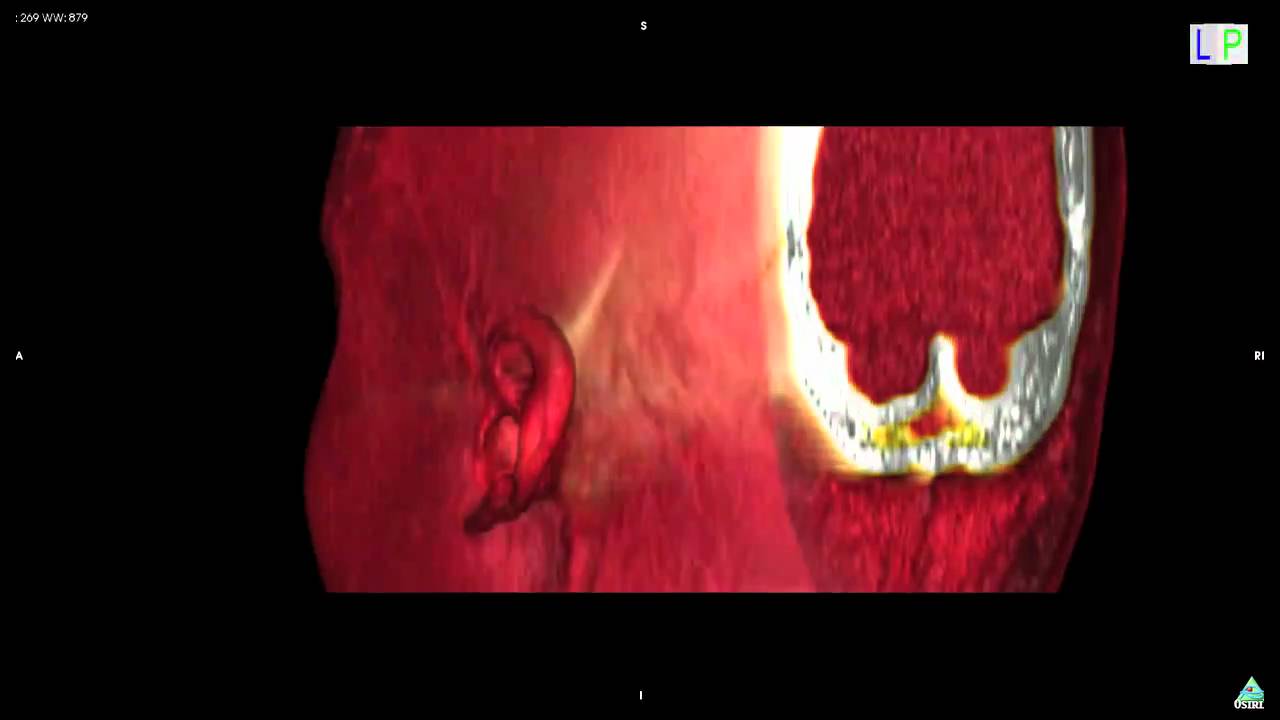 Head CT 3D Reconstruction - YouTube