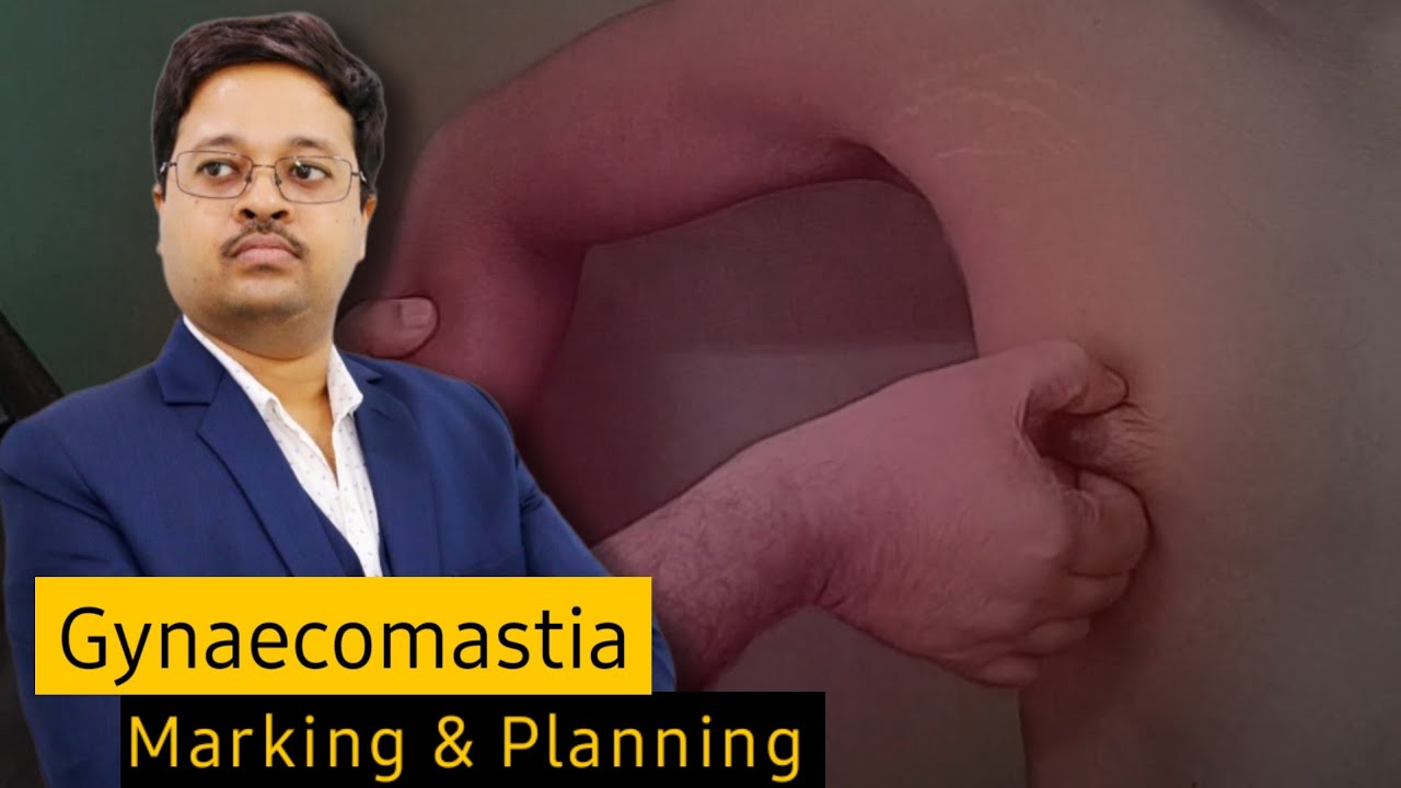 Gynecomastia Marking & Planing by Dr. Jayanta Bain plastic surgeon ...
