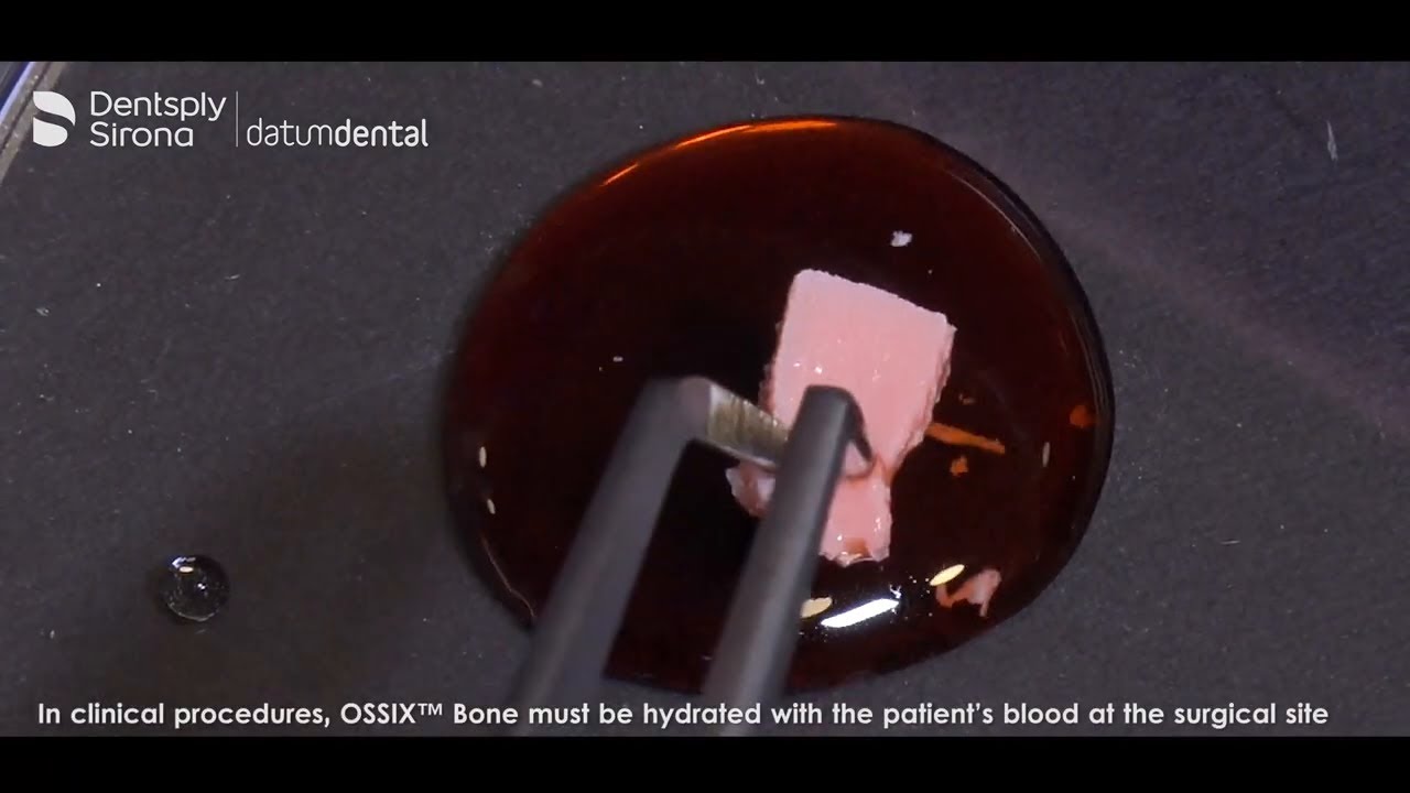 Lateral Bone Augmentation demonstration with OSSIX™ Bone & OSSIX® Plus ...