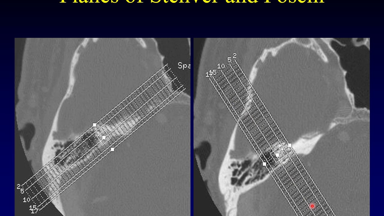 Temporal Bone Pathology 9: Dizziness - YouTube
